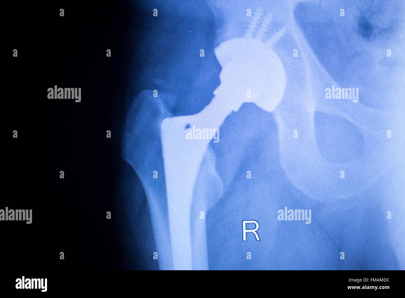Hip joint meniscus orthopedic titanium metal replacement implant xray ...