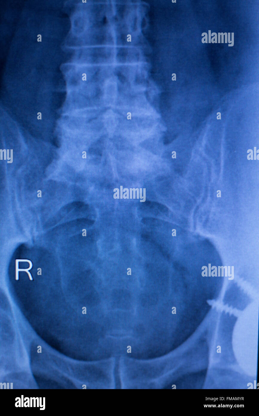 Spine vertebra back injury vertebral column medical x-ray test scan ...