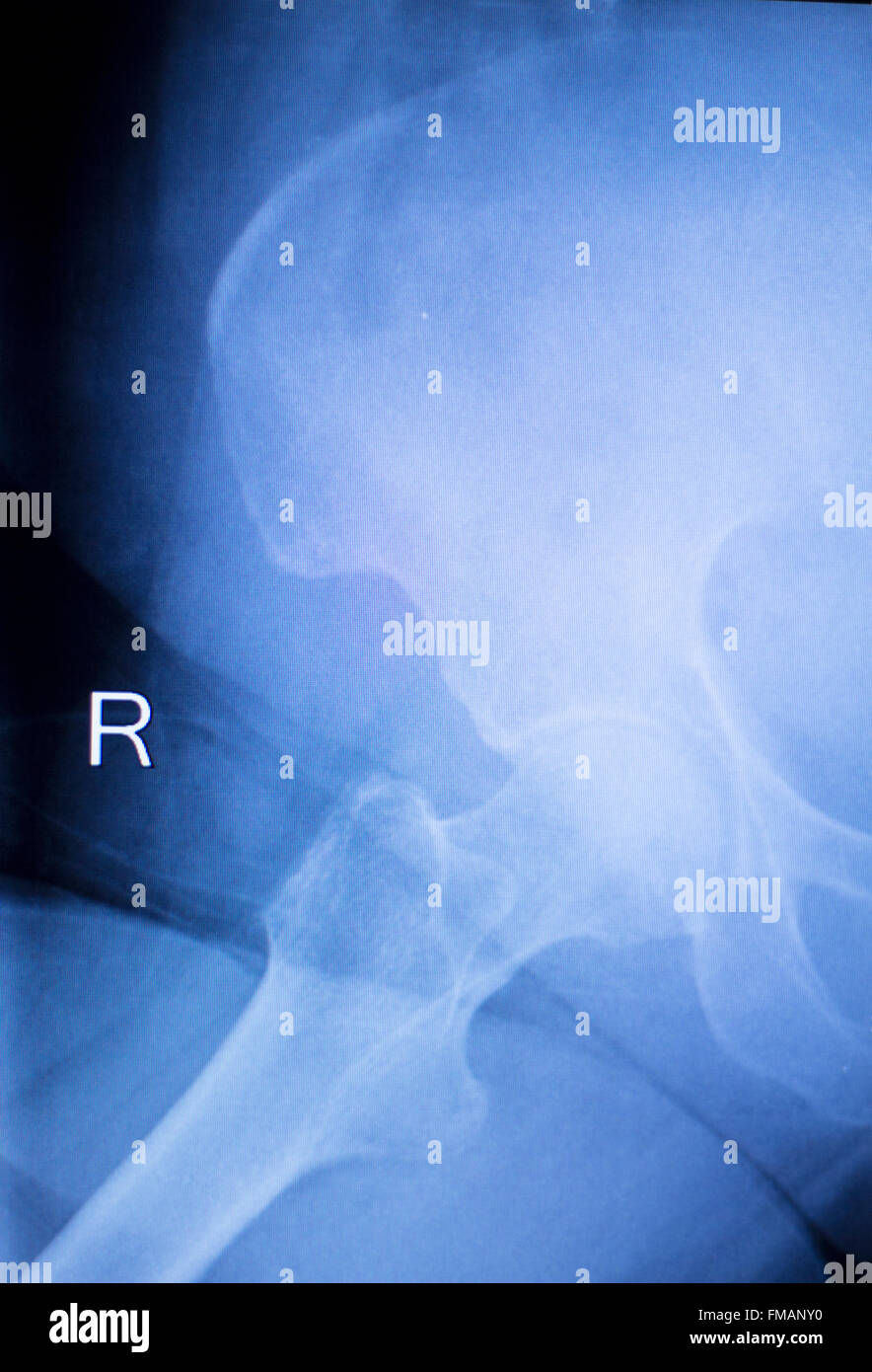 Hip, leg, thigh and pelvis injury medical x-ray test scan image of old ...