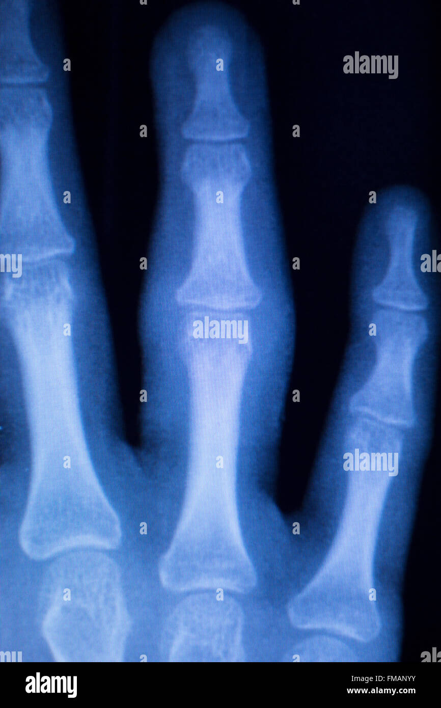 Hand and fingers injury orthopedic Traumatology medical x-ray test scan ...