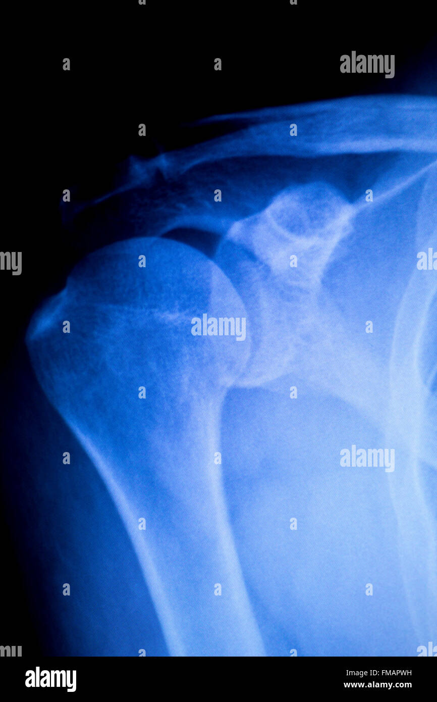 Hip, leg, thigh and pelvis injury medical x-ray test scan image of old ...