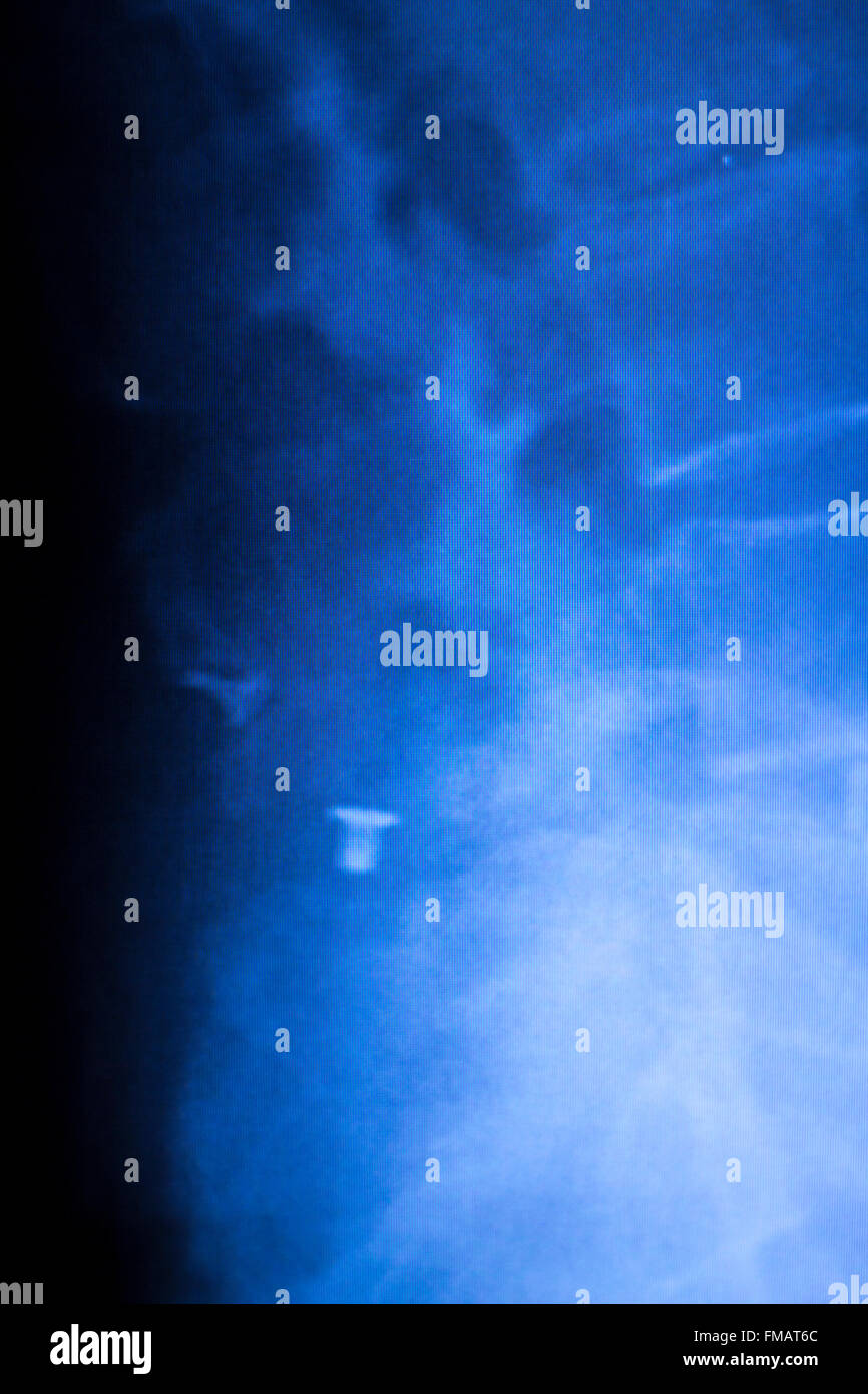 Spine back neck orthopedic titanium hi-res stock photography and images ...