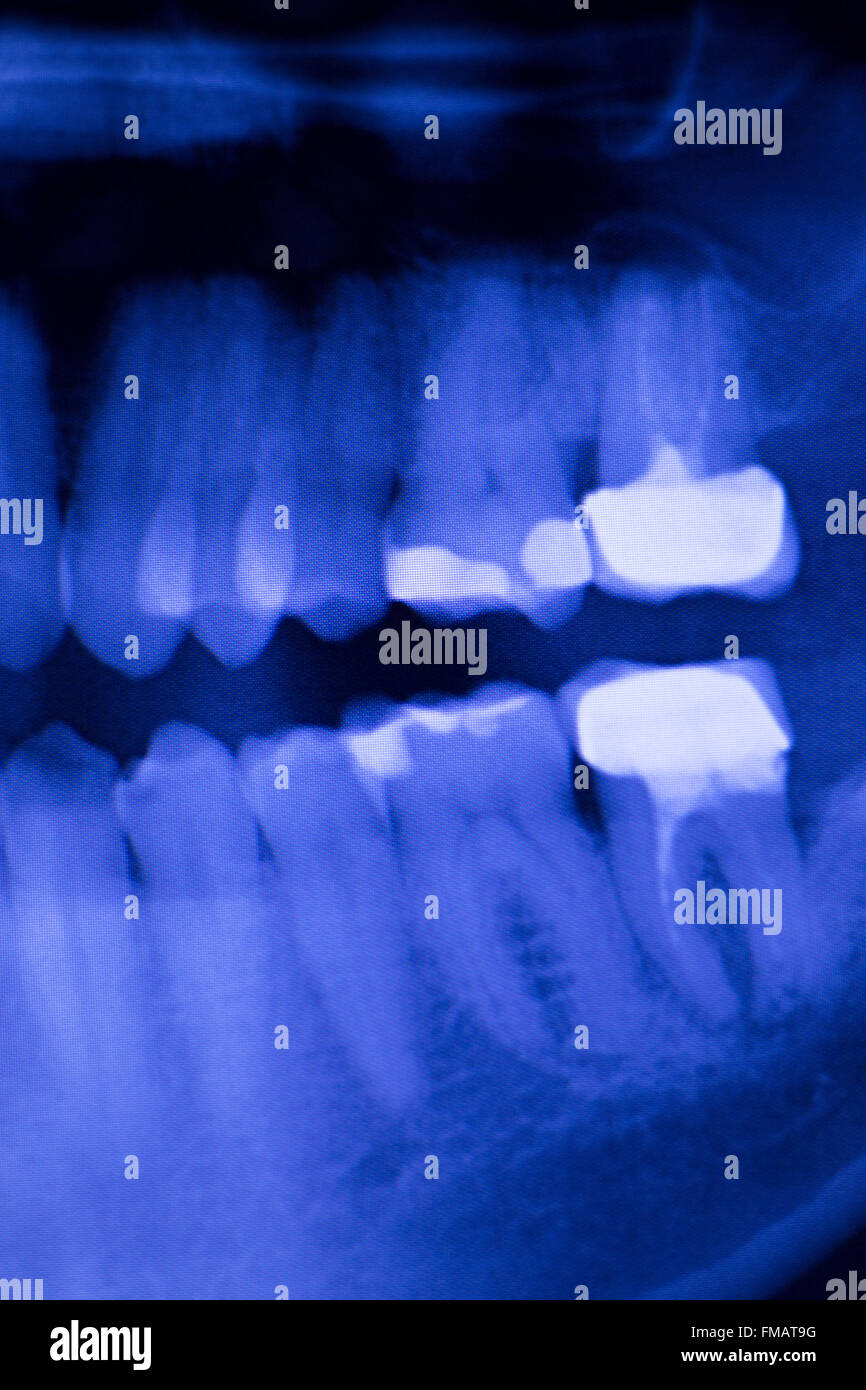 Dental teeth fillings, gum disease gingivitis dentists medical tooth x ...