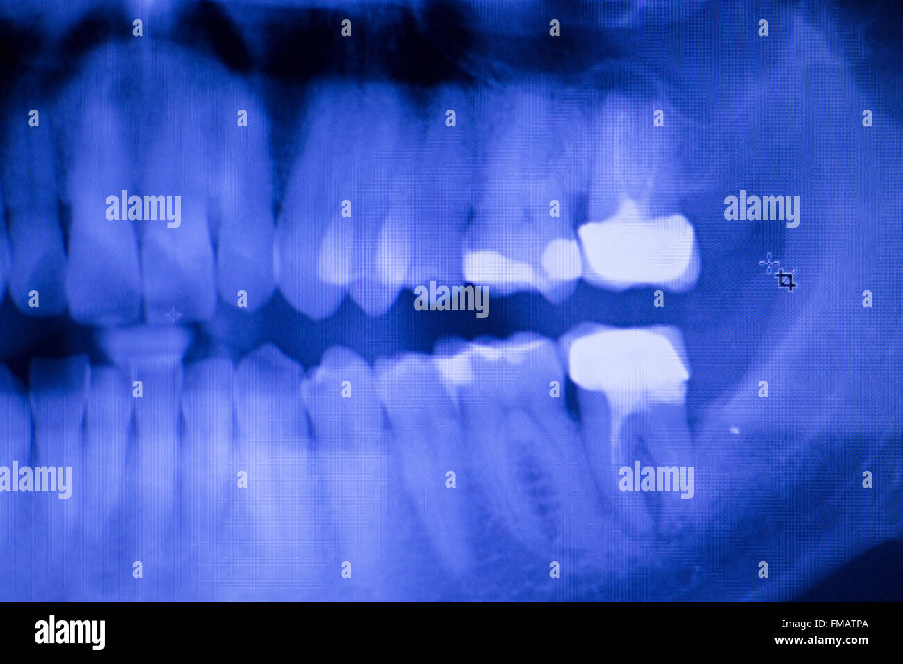 Dental teeth fillings, gum disease gingivitis dentists medical tooth x ...