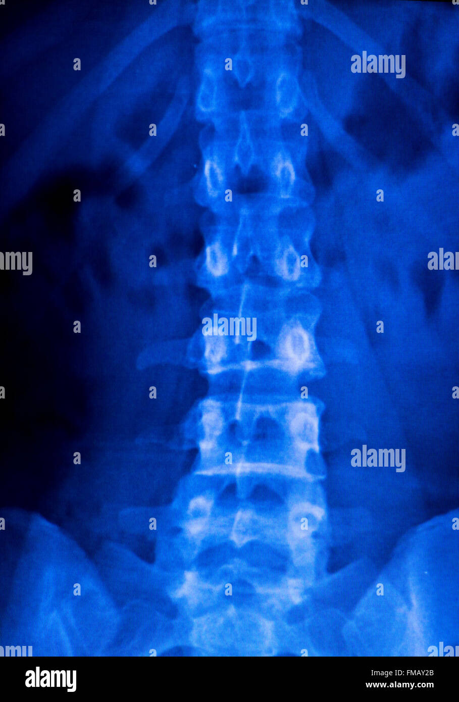Spine vertebra back injury vertebral column medical x-ray test scan ...