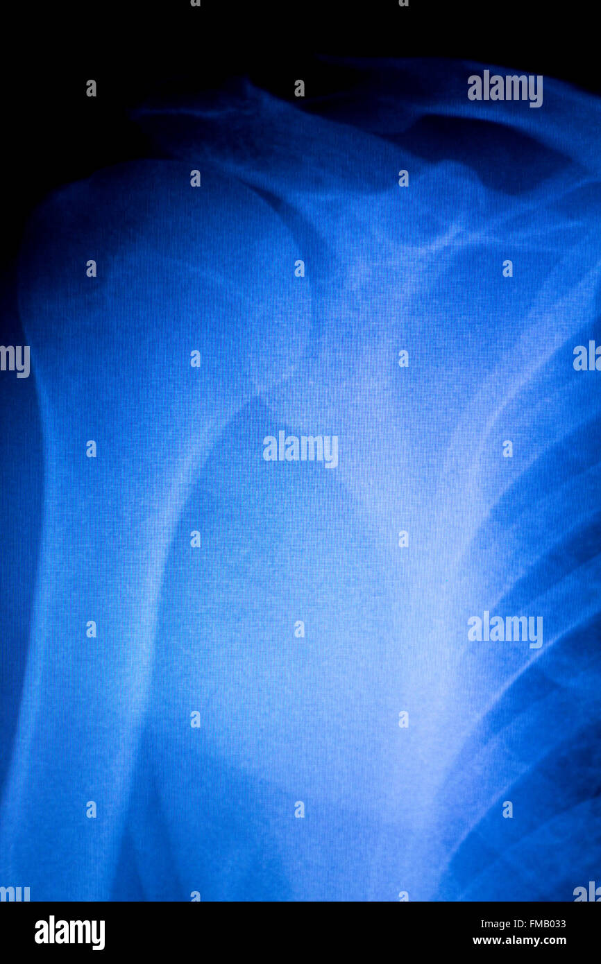 Shoulder joint orthopedics xray scan test reults to diagnose pain and ...