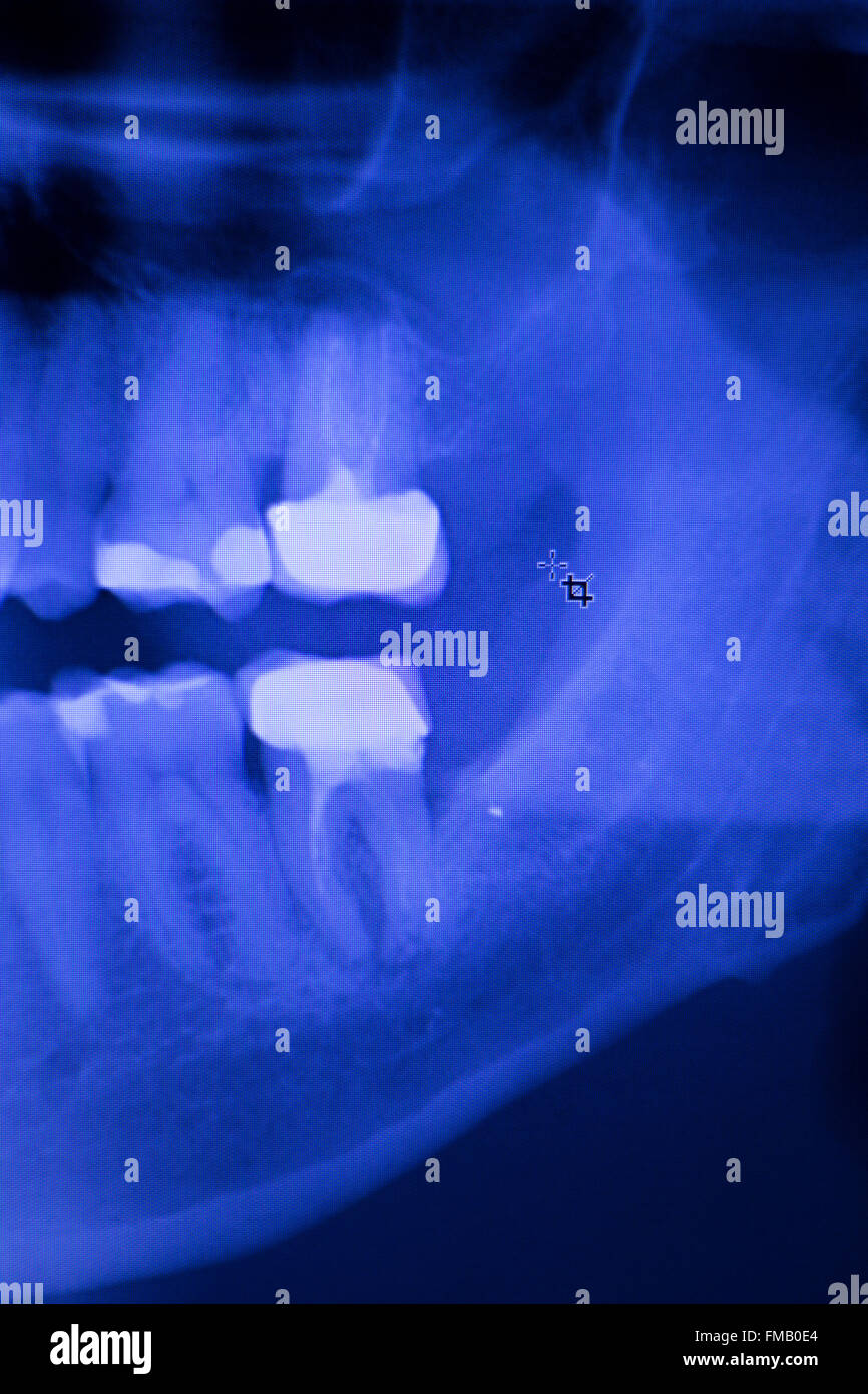 Dental teeth fillings, gum disease gingivitis dentists medical tooth x ...