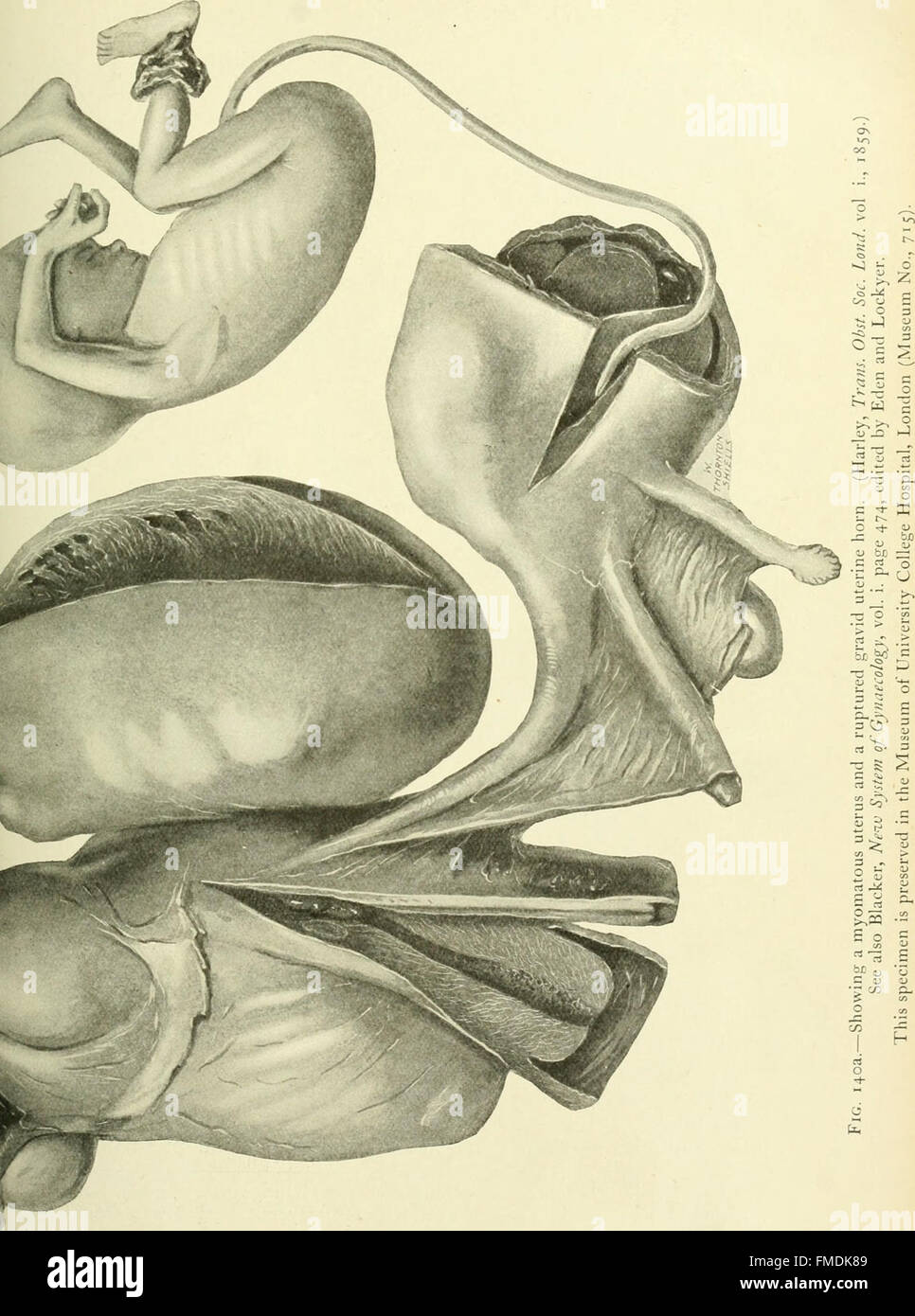 Fibroids and allied tumours (myoma and adenomyoma) - their pathology ...
