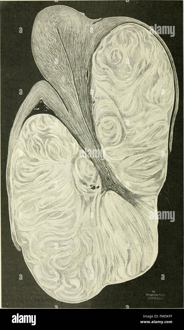 Adenomyoma hi-res stock photography and images - Alamy