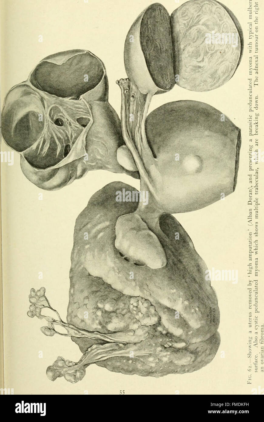 Fibroids and allied tumours (myoma and adenomyoma) - their pathology ...
