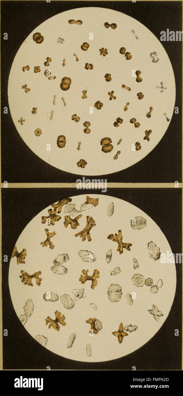 A 1871 atlas of physiological and pathological urinary sediments ...