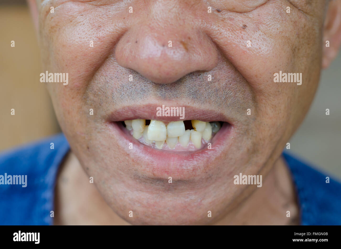 broken tooth in senior men Stock Photo - Alamy