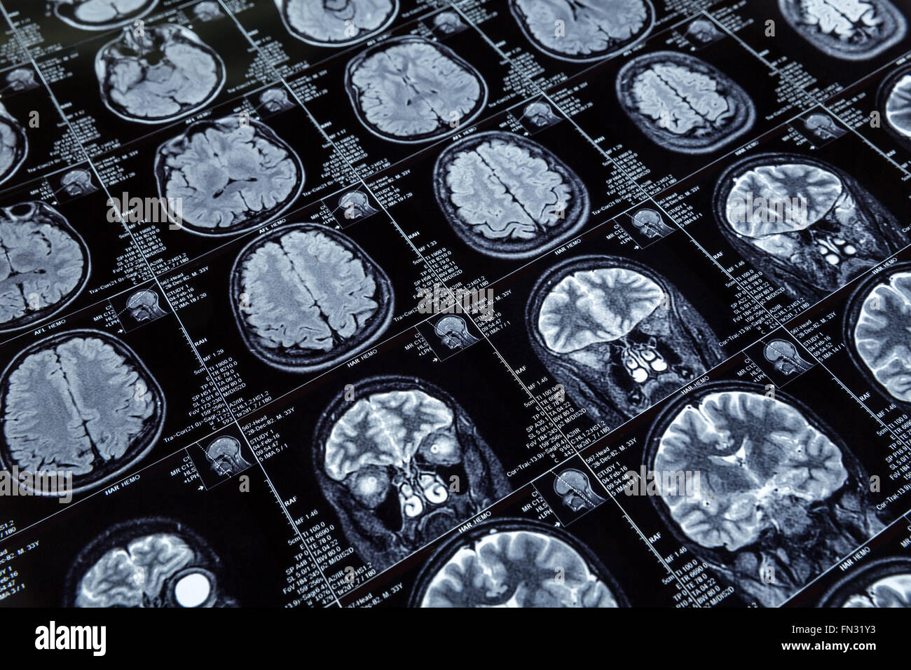 Brain death imaging hi-res stock photography and images - Alamy