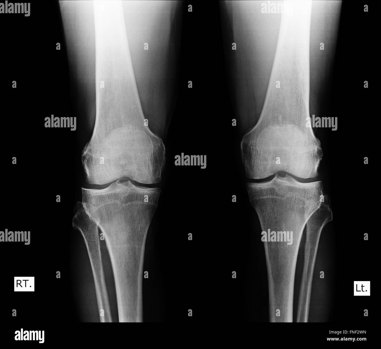 Total knee replacement hi-res stock photography and images - Alamy