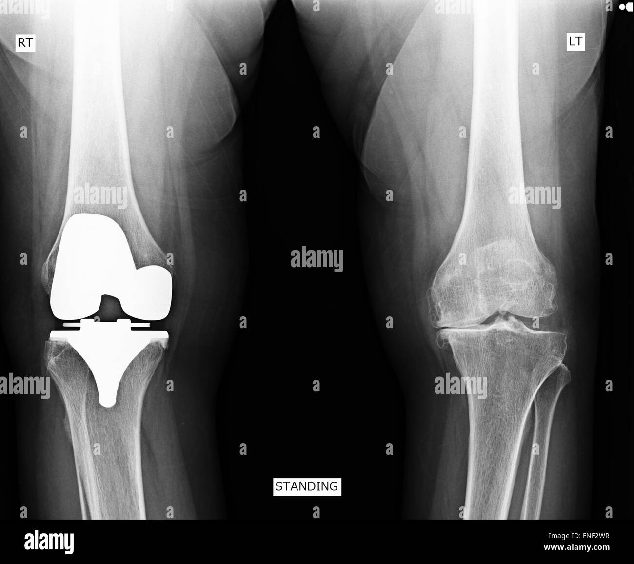 Total knee replacement x ray Black and White Stock Photos & Images - Alamy