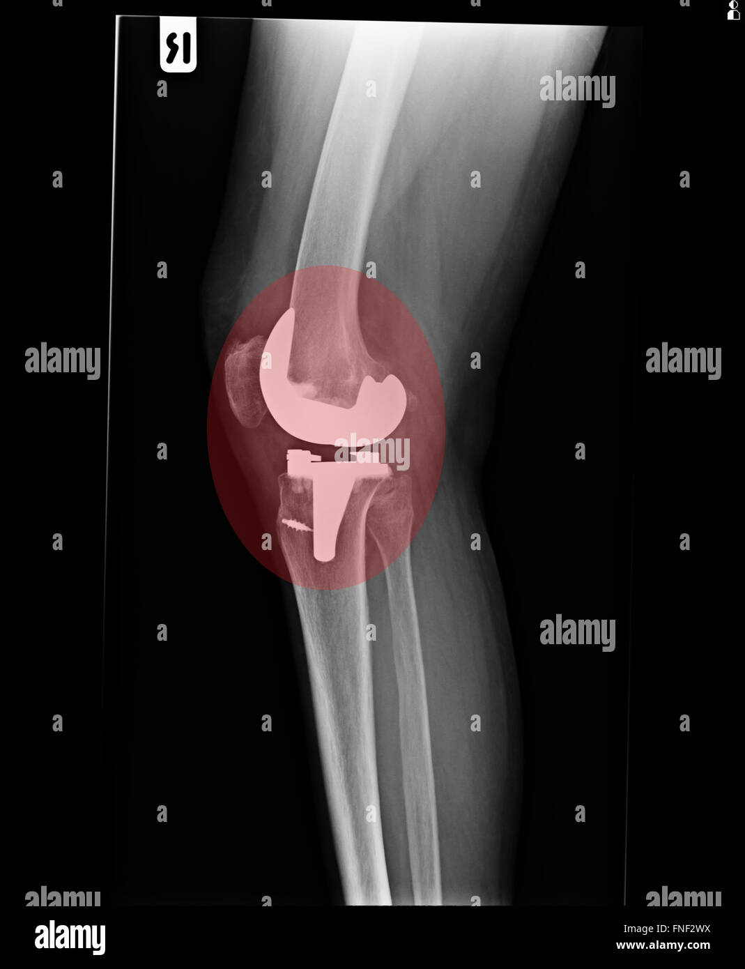 Total knee replacement hi-res stock photography and images - Alamy