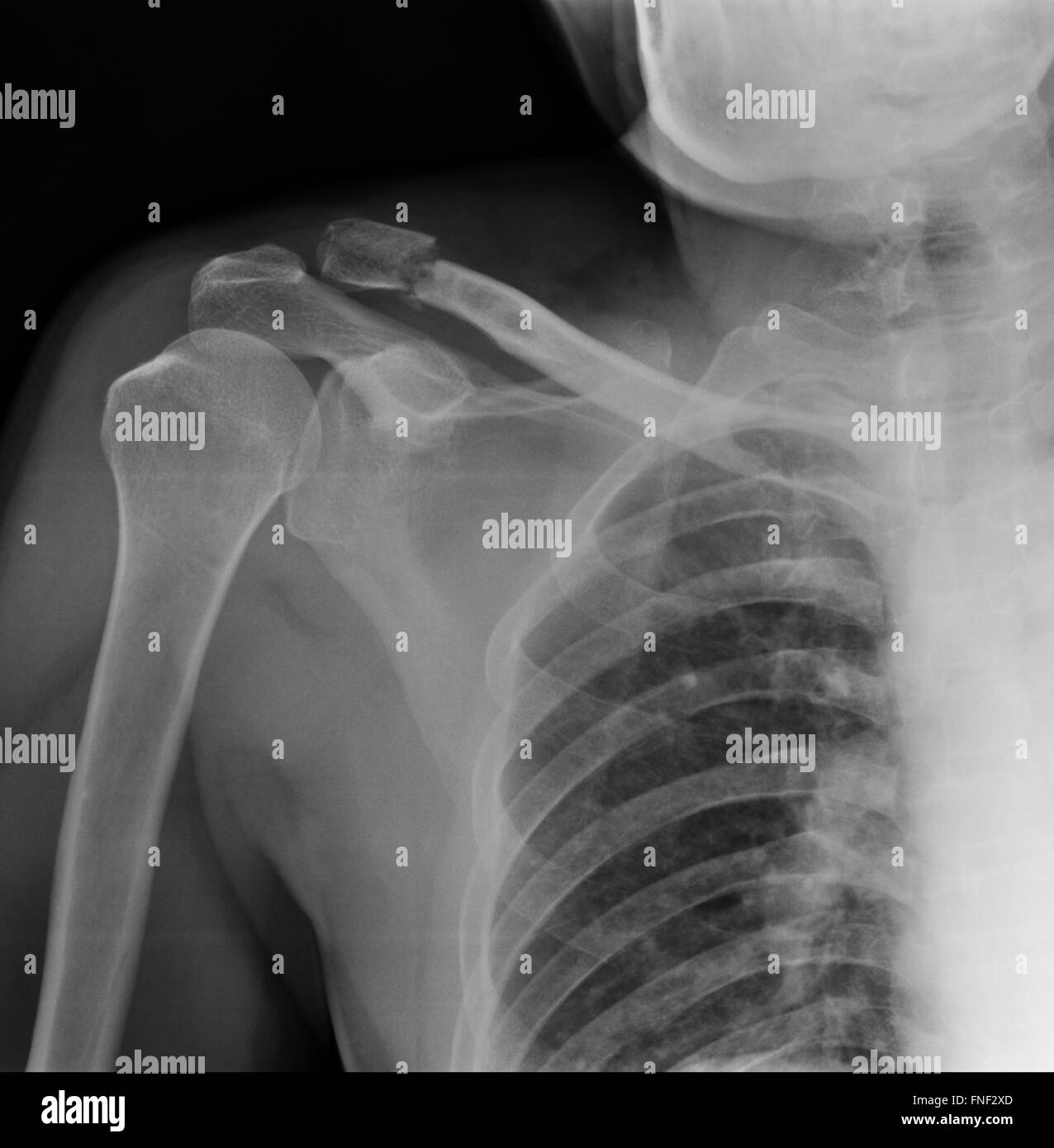 Head and shoulder bone Black and White Stock Photos & Images - Alamy