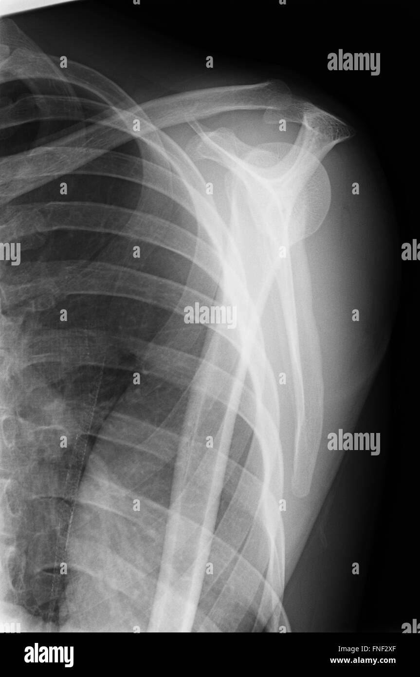 Head and shoulder bone Black and White Stock Photos & Images - Alamy