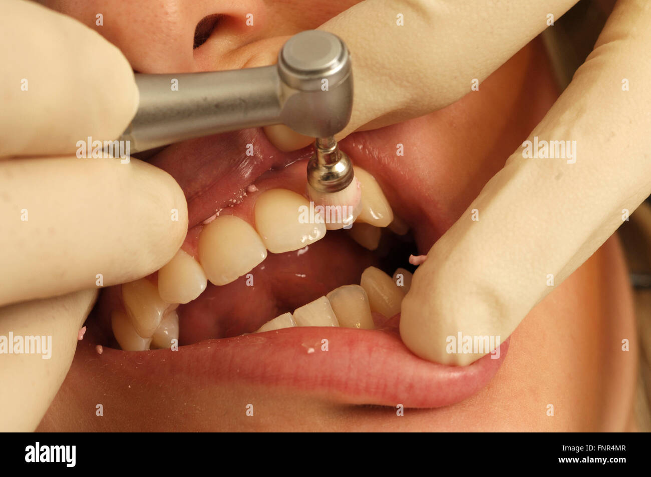 Young boy having his teeth checked and cleaned at the dentist Stock ...