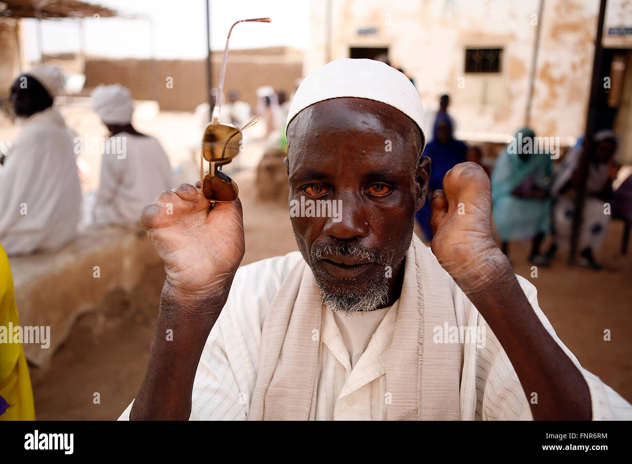 Leprosy patient known also as Leper,a disease called by Mycobacterium ...