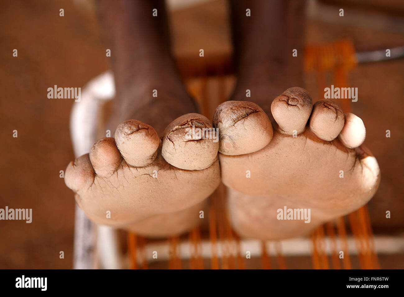 Leprosy patient known also as Leper,a disease called by Mycobacterium ...