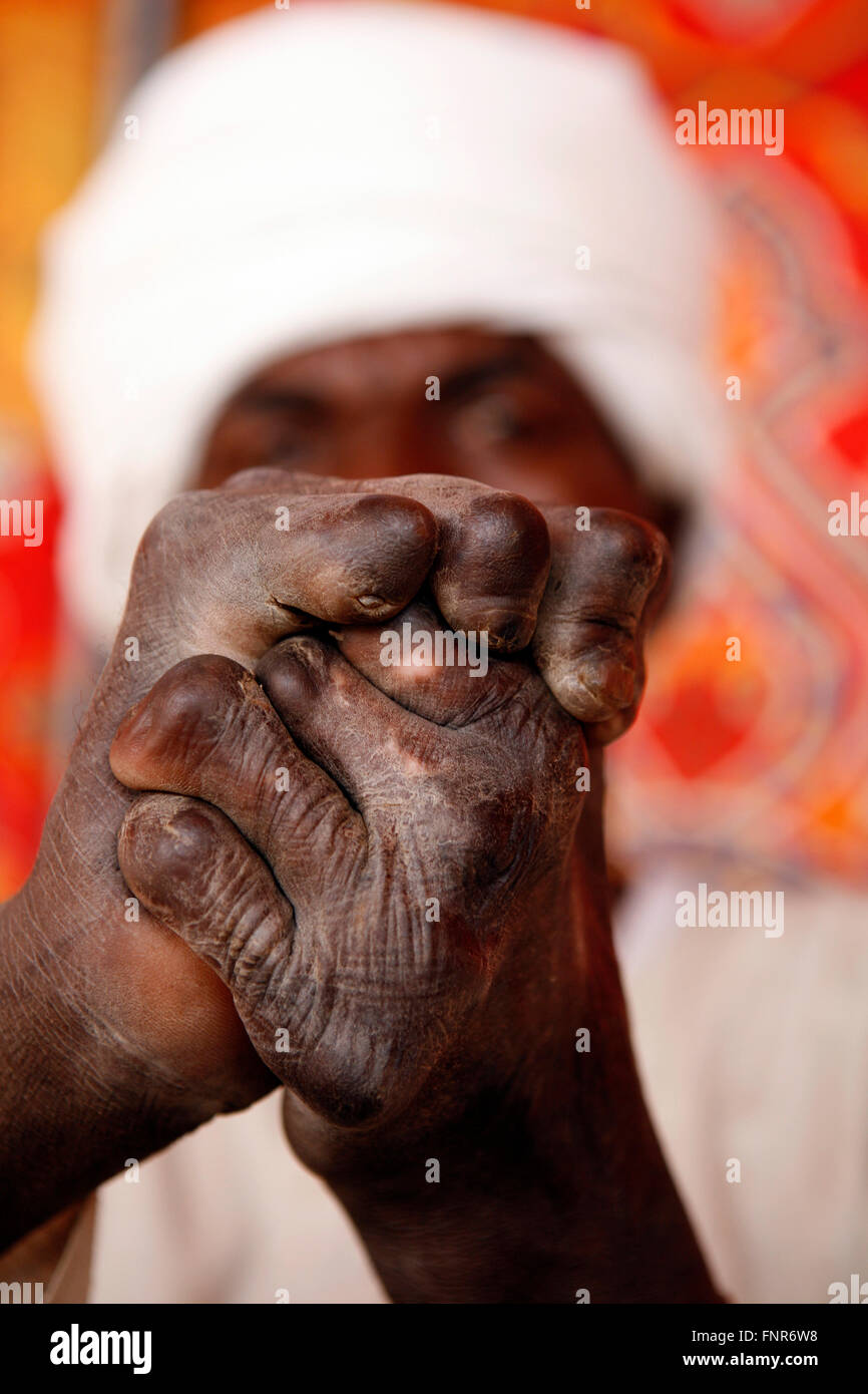 Leprosy patient known also as Leper,a disease called by Mycobacterium ...