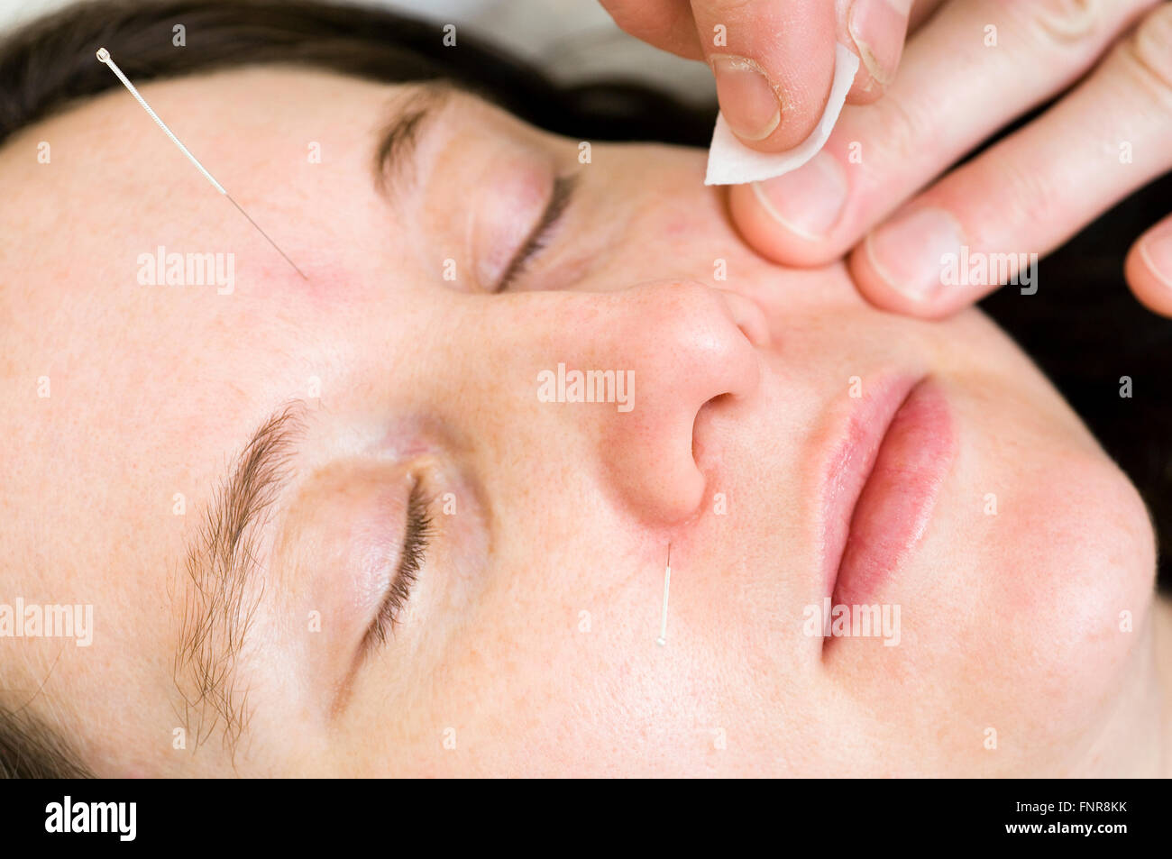 Acupuncturist uses a sterilized swab to cleanse a female patients face ...