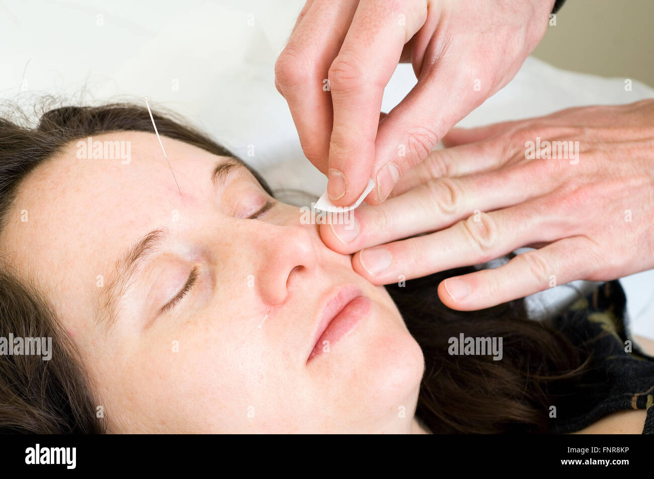 Acupuncture needles, as fine as hair, being inserted into the forehead ...