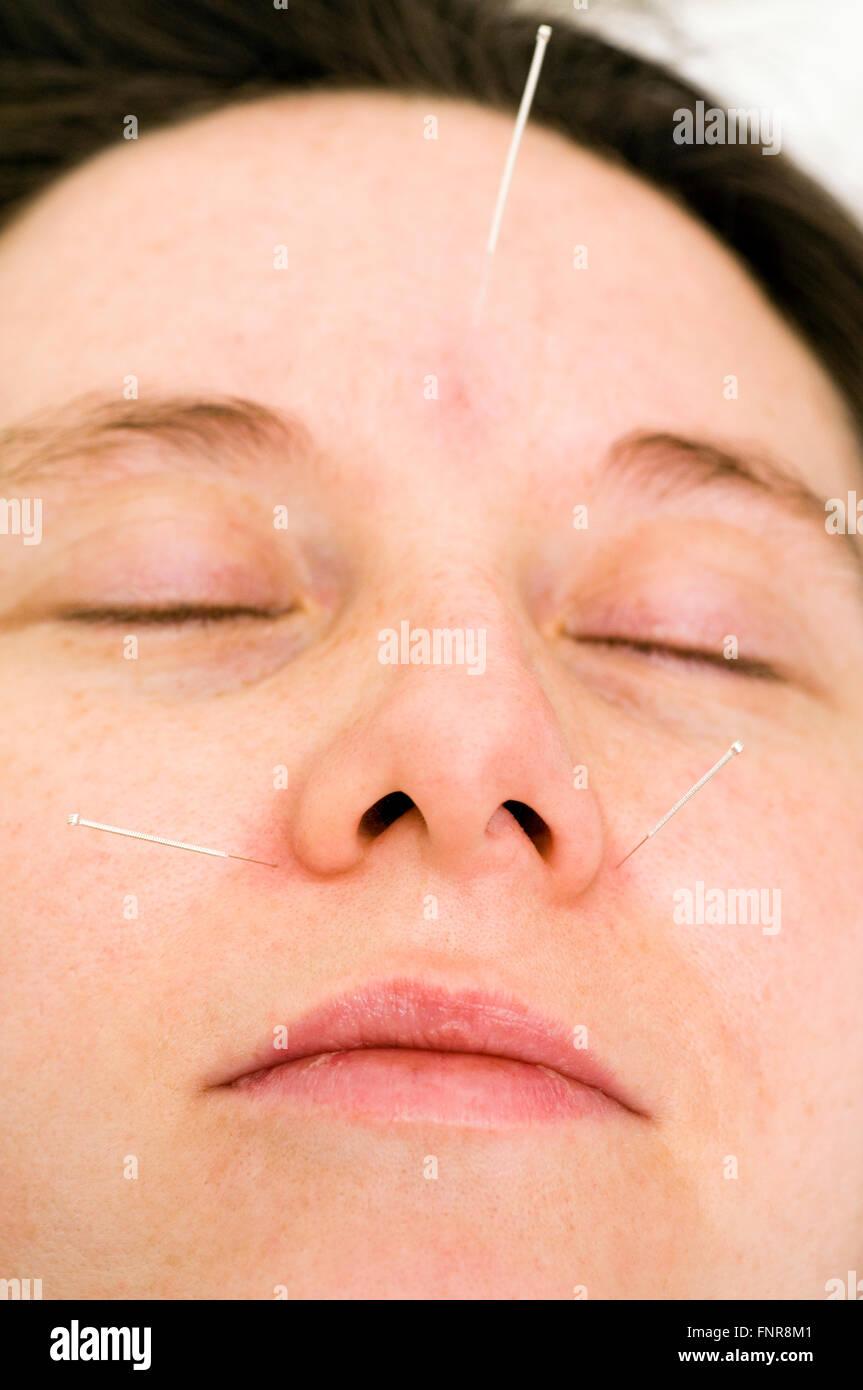 Acupuncture needles, as fine as hair, being inserted into the forehead ...