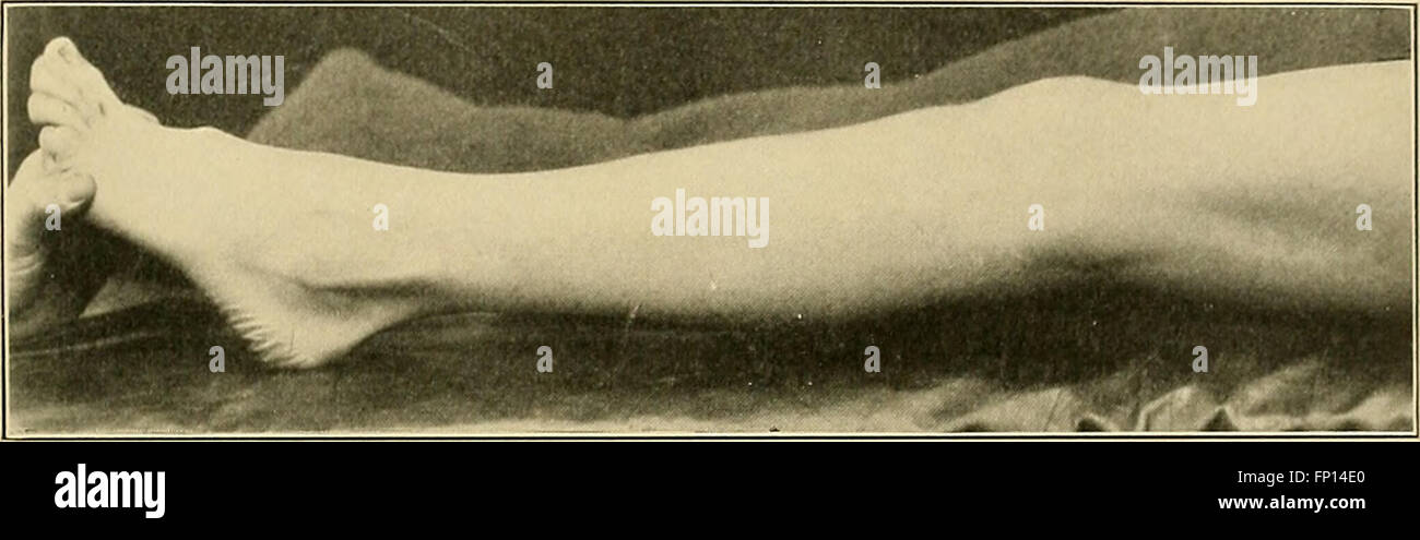 *The Treatment of Fractures* (1901) provides an in-depth examination of ...