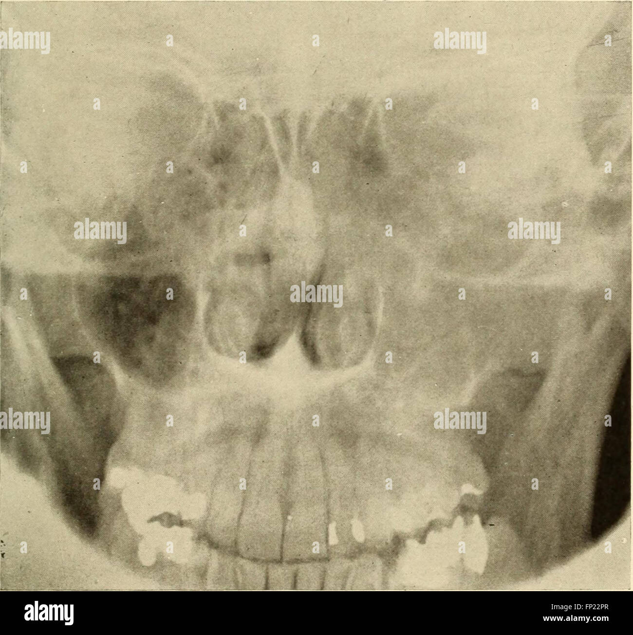 Oral Roentgenology - a Roentgen study of the anatomy and pathology of ...