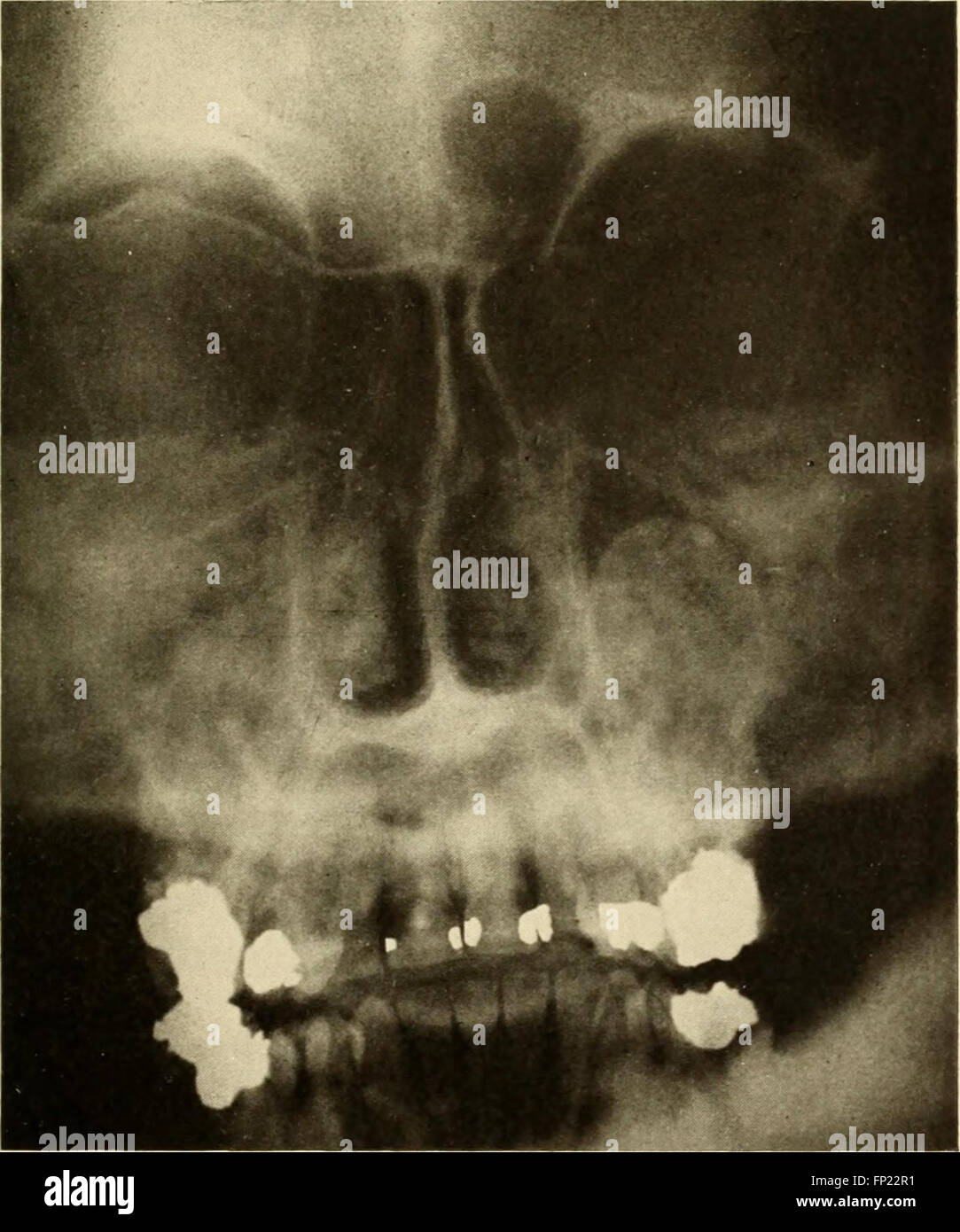 Oral Roentgenology - a Roentgen study of the anatomy and pathology of ...