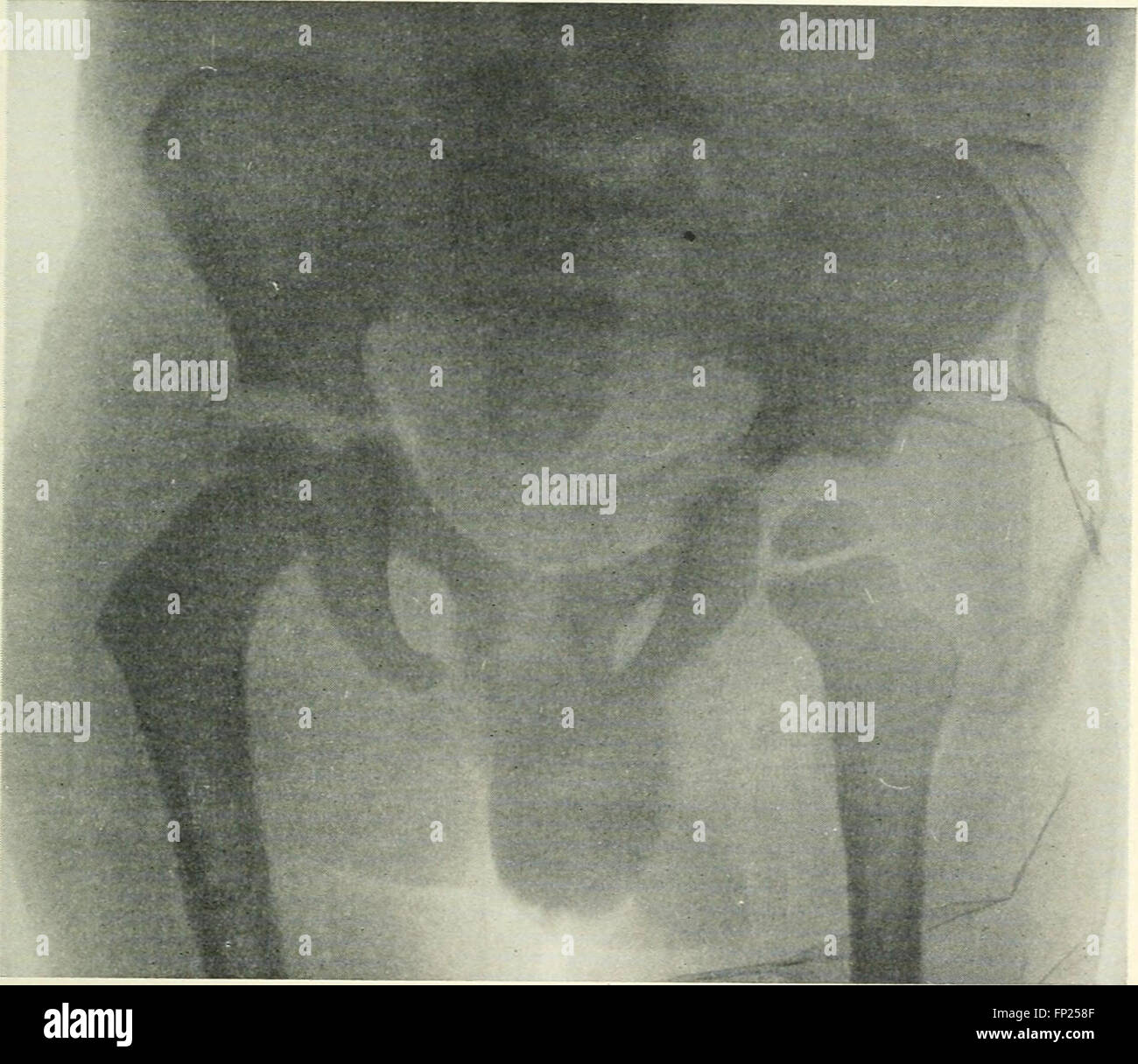 'Radiography, X-ray Therapeutics and Radium Therapy' (1915) provides a ...