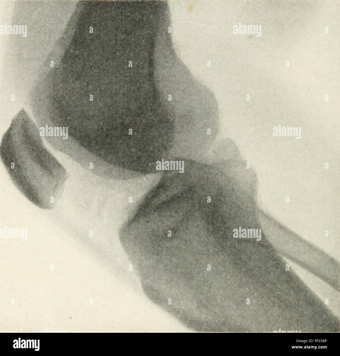 This work from 1915 examines the use of X-rays and radium in ...