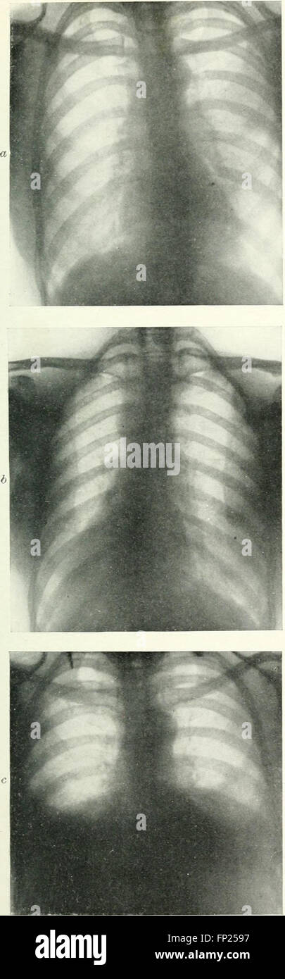 Radiography, x-ray therapeutics and radium therapy (1915 Stock Photo ...