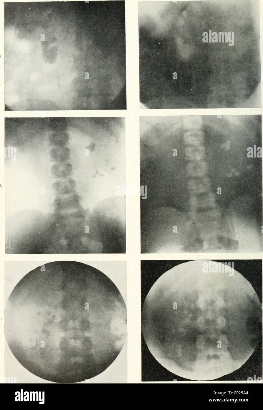 Published in 1915, this work covers the use of radiography, X-ray ...