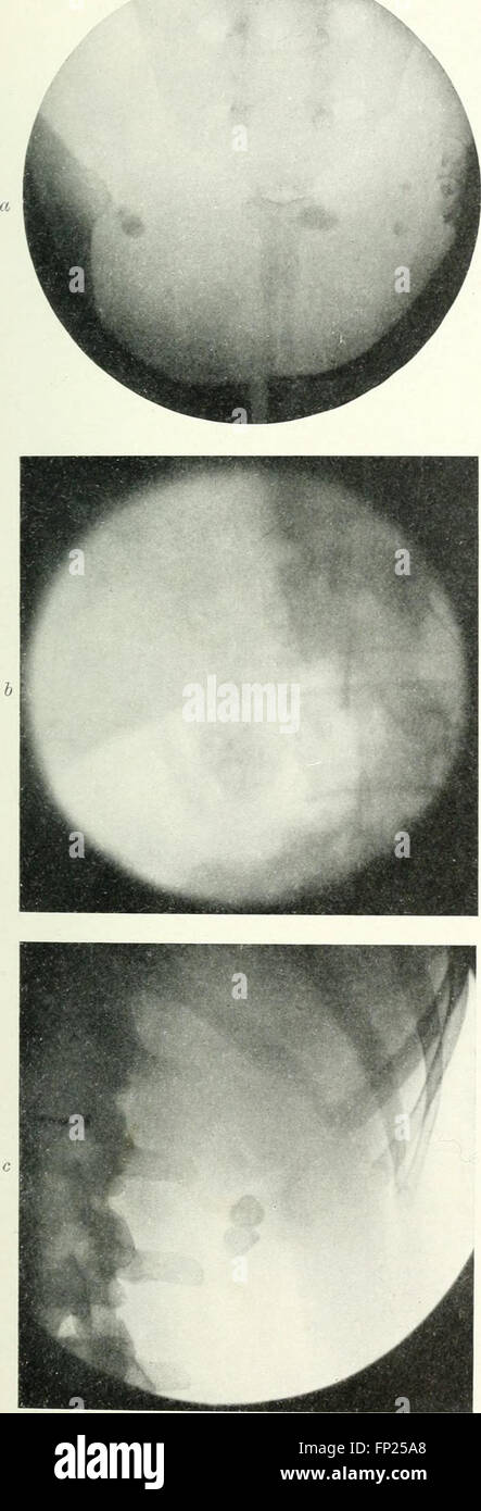 Radiography, x-ray therapeutics and radium therapy (1915 Stock Photo ...