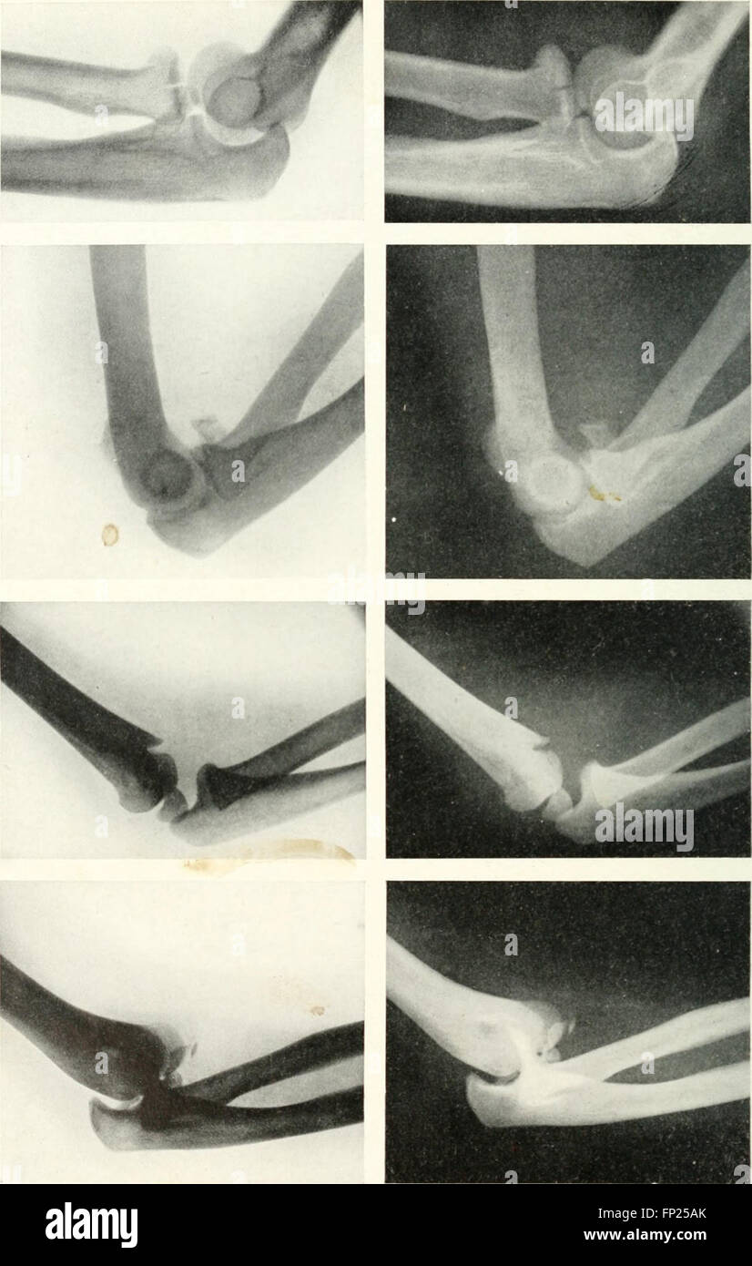 This 1915 work covers the advancements in radiography, the use of X ...