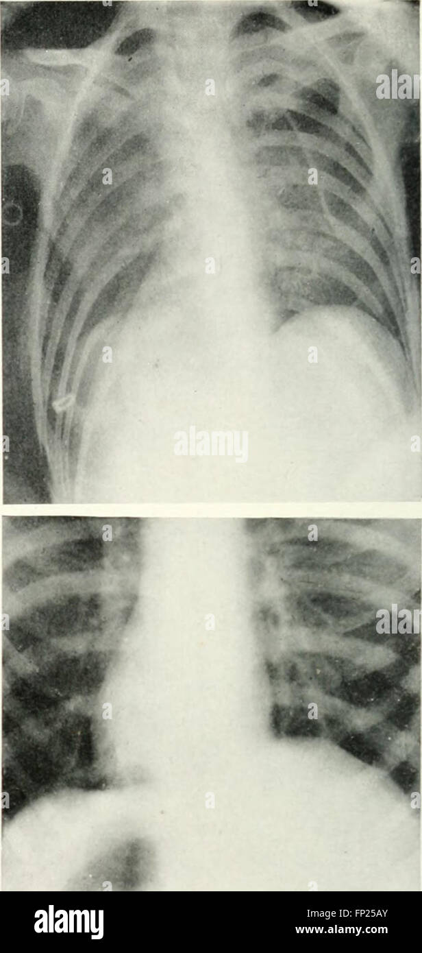This 1915 work discusses the use of radiography, X-ray therapeutics ...