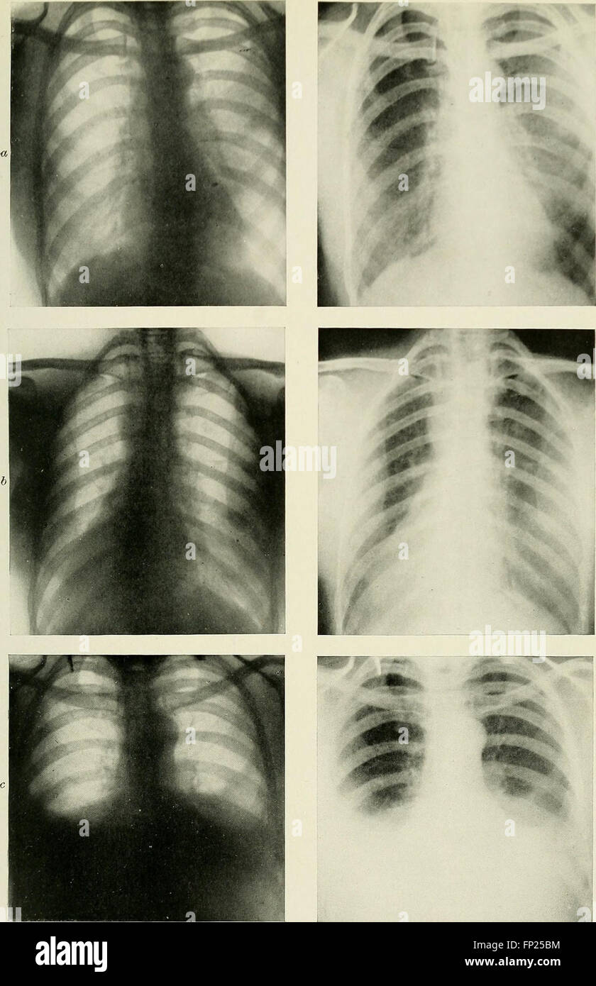 Radium therapy hi-res stock photography and images - Alamy
