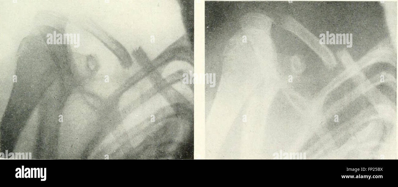 Radiography, x-ray therapeutics and radium therapy (1915 Stock Photo ...