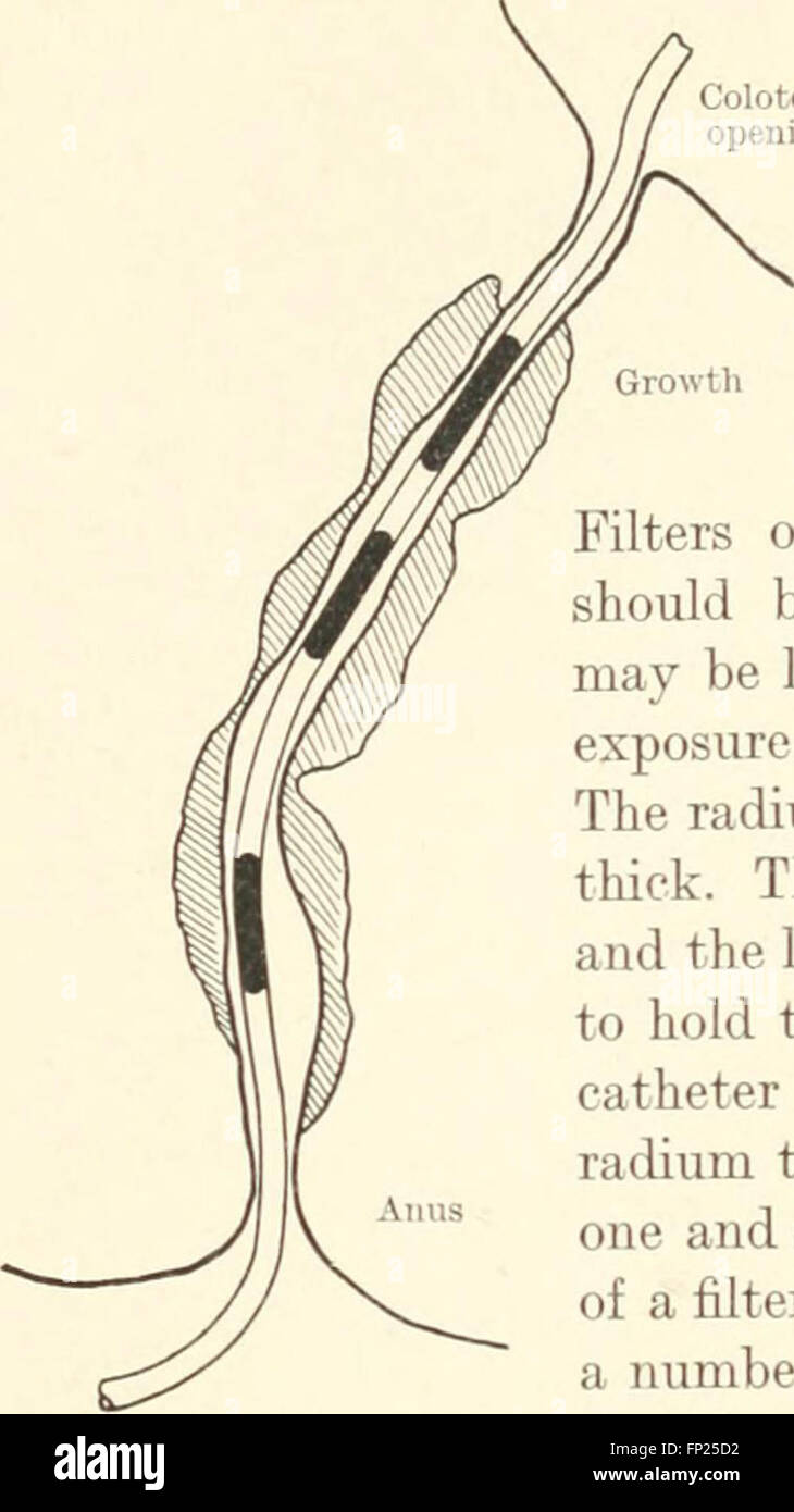 Radiography, x-ray therapeutics and radium therapy (1915 Stock Photo ...