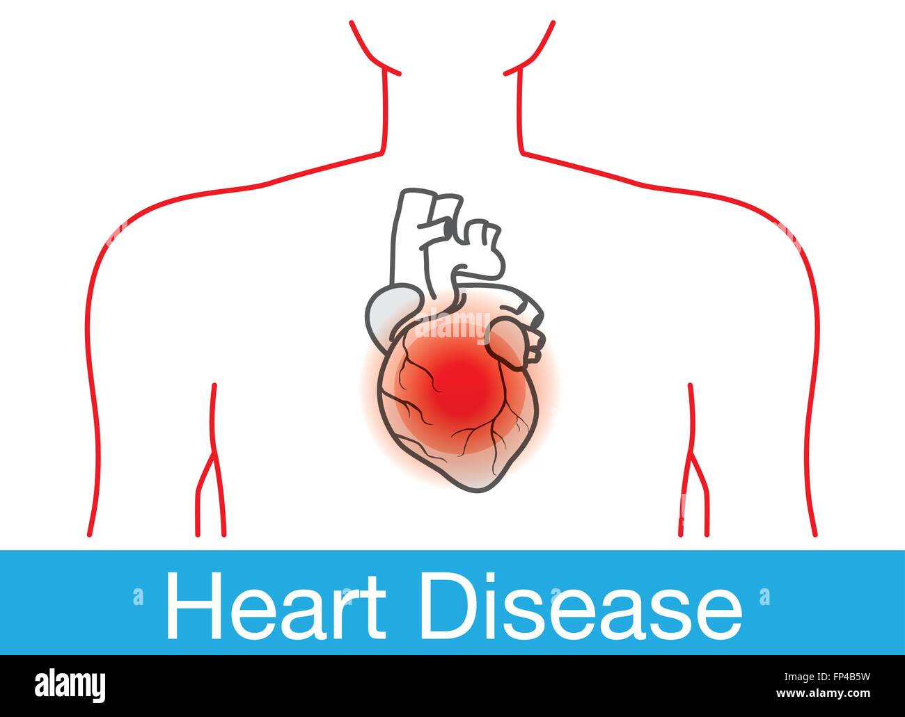 Heart attack warning illustration Stock Vector Images - Alamy