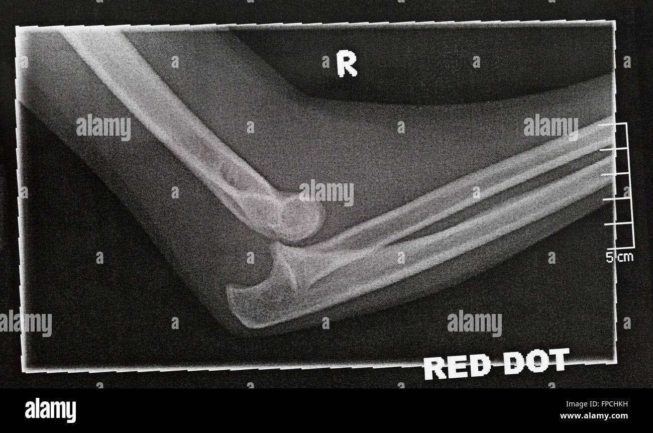 X ray elbow hi-res stock photography and images - Alamy