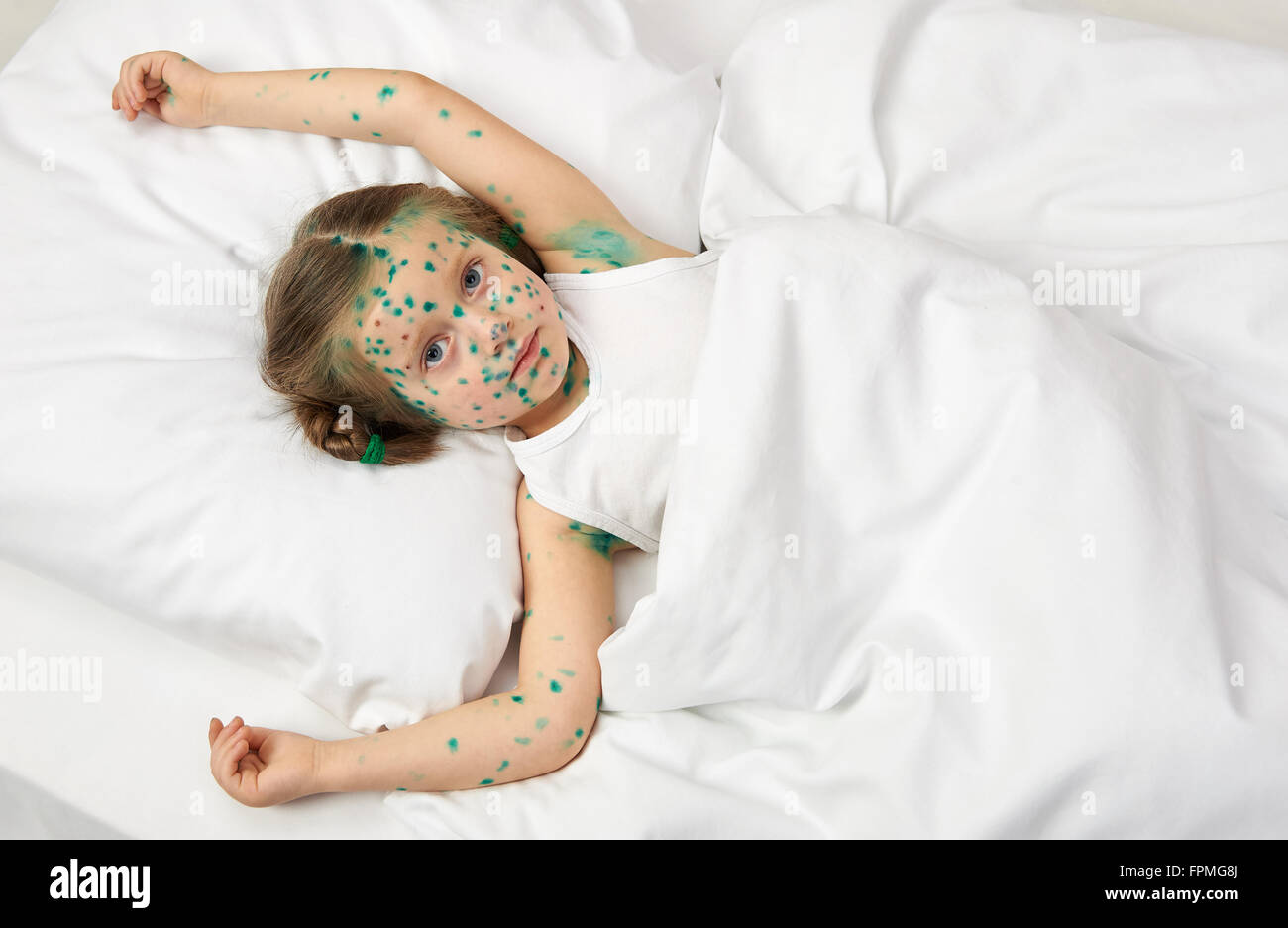 sick child has the virus on skin Stock Photo - Alamy