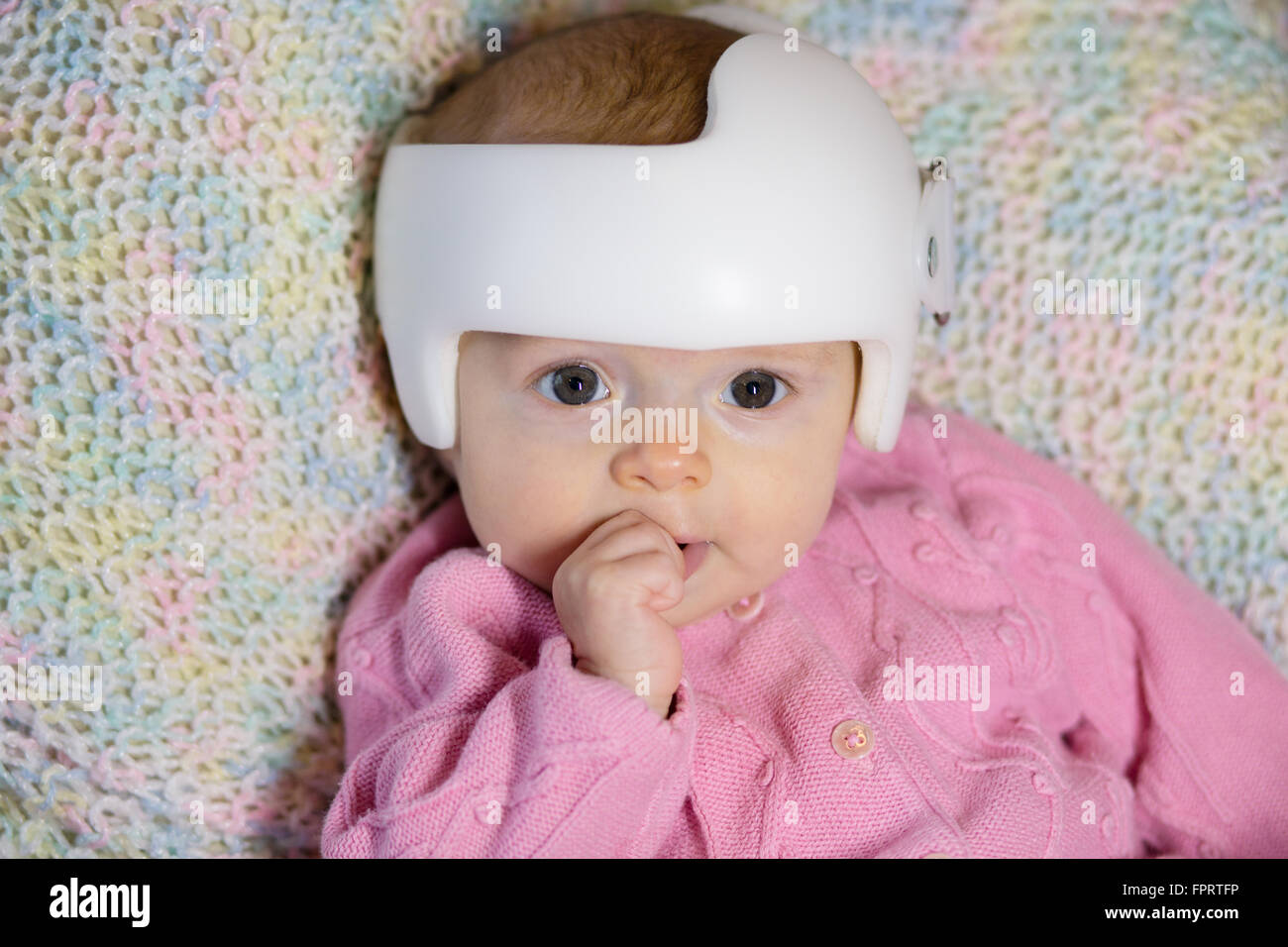 Dolichocephaly baby hi-res stock photography and images - Alamy