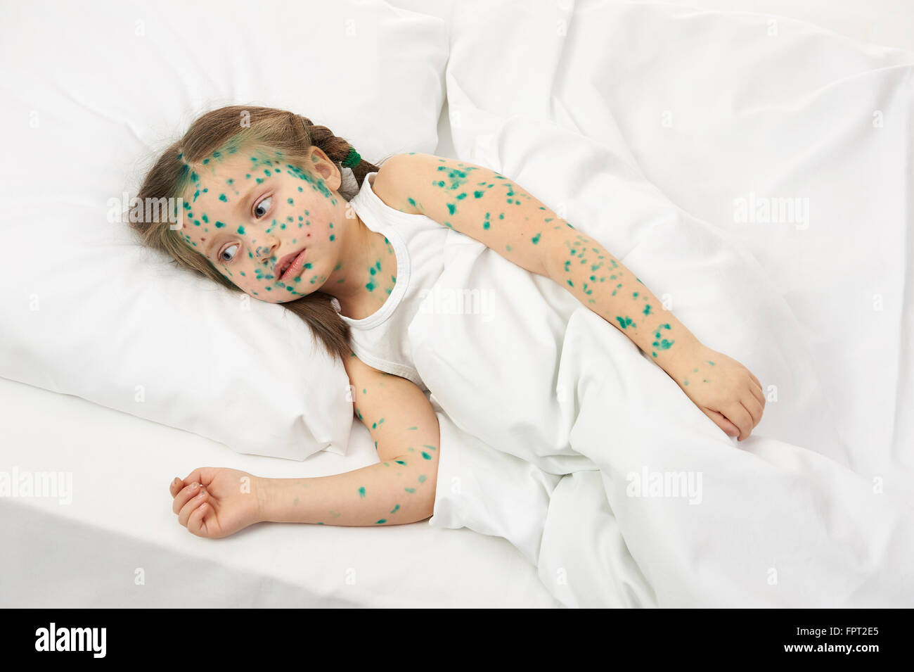 sick child has the virus on skin Stock Photo - Alamy