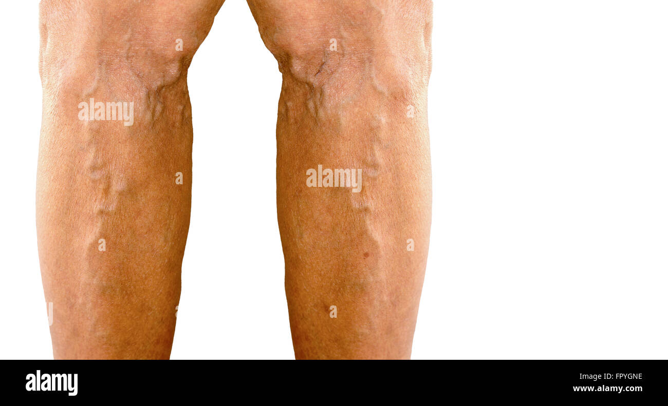 Old woman with varicose veins hi-res stock photography and images - Alamy