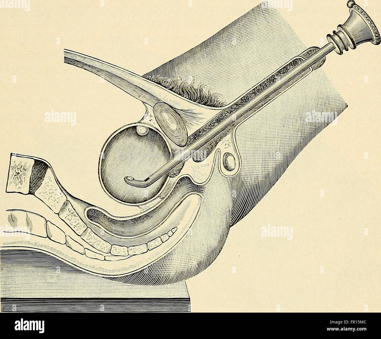 This 1893 book, 'A System of Genito-Urinary Diseases, Syphilology, and ...