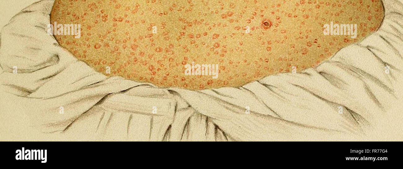 A manual of syphilis and the venereal diseases, (1900 Stock Photo - Alamy